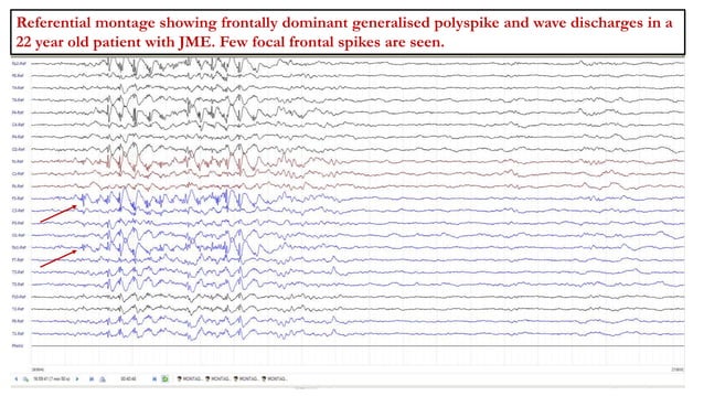 Abnormal focal eeg patterns | PPTX
