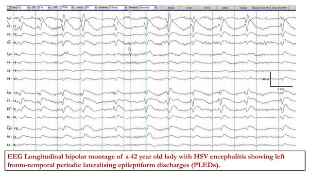 Abnormal focal eeg patterns | PPTX