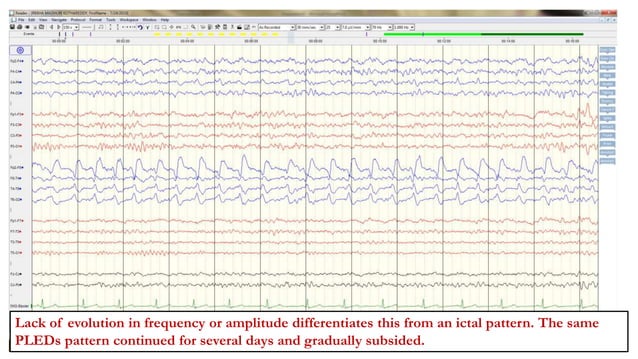 Abnormal focal eeg patterns | PPTX