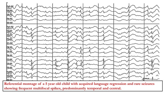 Abnormal focal eeg patterns | PPTX