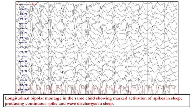 Abnormal focal eeg patterns | PPTX