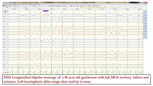 Abnormal focal eeg patterns | PPTX