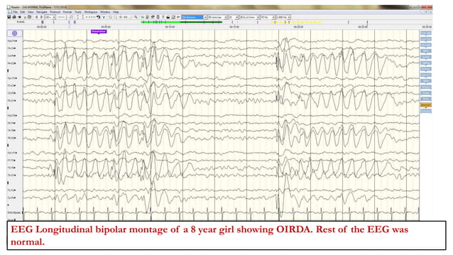 Abnormal focal eeg patterns | PPTX