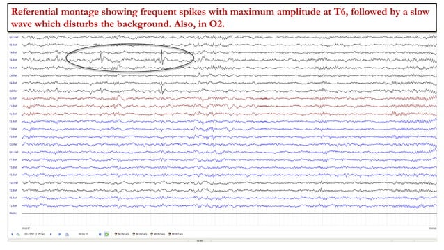 Abnormal focal eeg patterns | PPTX