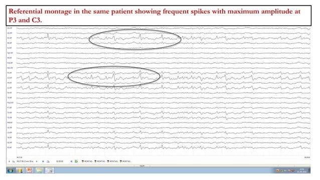 Abnormal focal eeg patterns