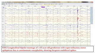 Abnormal Eeg Test Results