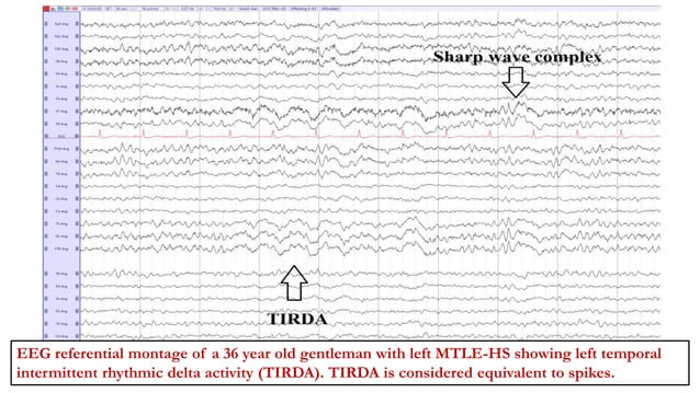 Abnormal focal eeg patterns