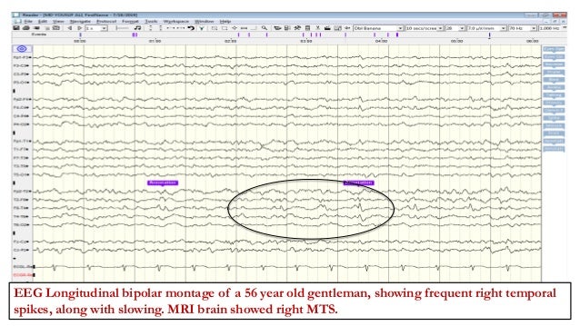 Abnormal focal eeg patterns