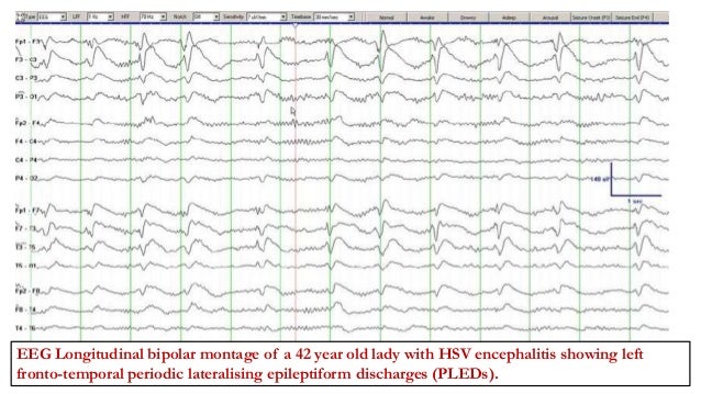 Abnormal focal eeg patterns