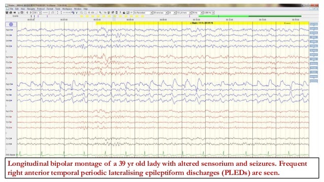 Abnormal focal eeg patterns