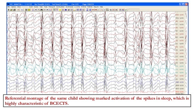 Abnormal focal eeg patterns