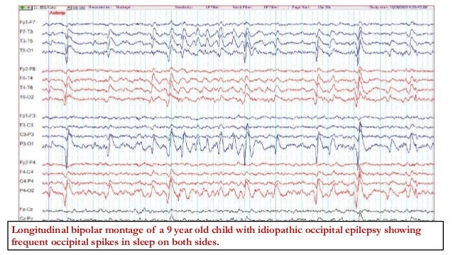 Abnormal focal eeg patterns