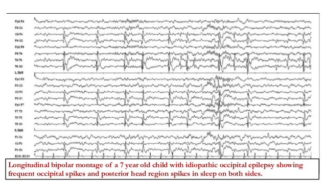 Abnormal focal eeg patterns
