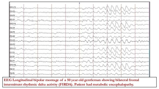 Abnormal focal eeg patterns