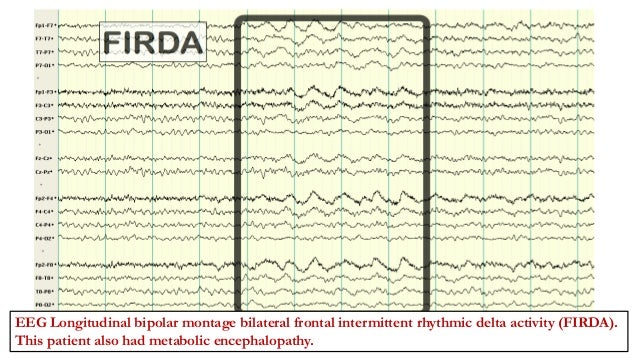 Abnormal focal eeg patterns