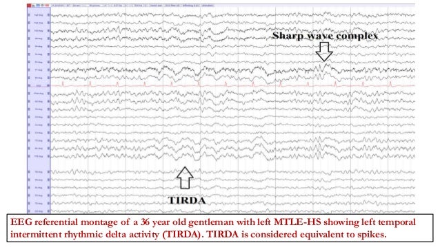 Sirpids An Unusual Eeg Pattern In A Critically Ill