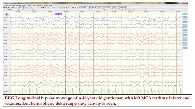 Abnormal focal eeg patterns