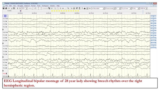 Abnormal focal eeg patterns