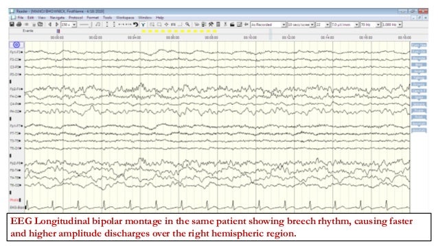 Abnormal focal eeg patterns