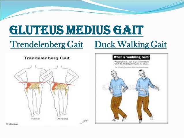 Abnormal gait by SURYA LIKHITA-VAPMS COLLEGE OF PHYSIOTHERAPY | PDF ...