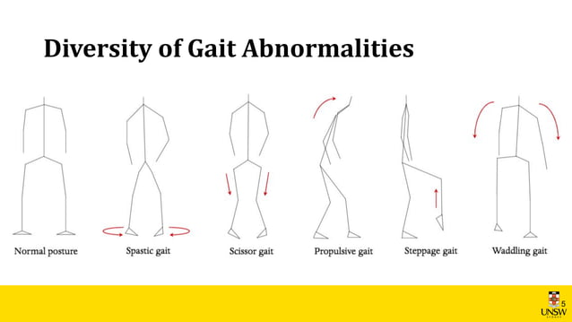 Abnormal Gait Recognition In Real Time Using Recurrent Neural Networks