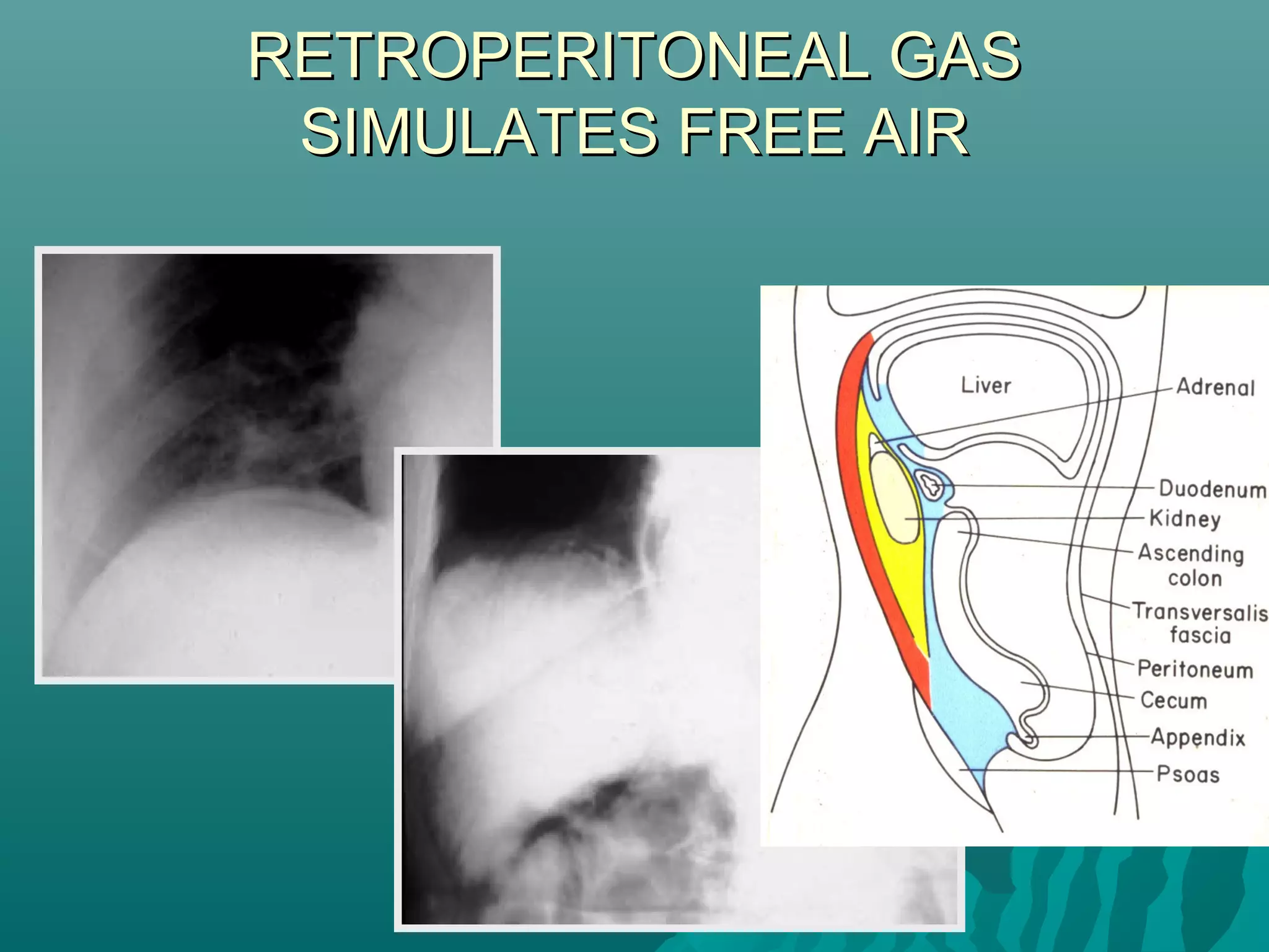 Abnormal gas | PPT