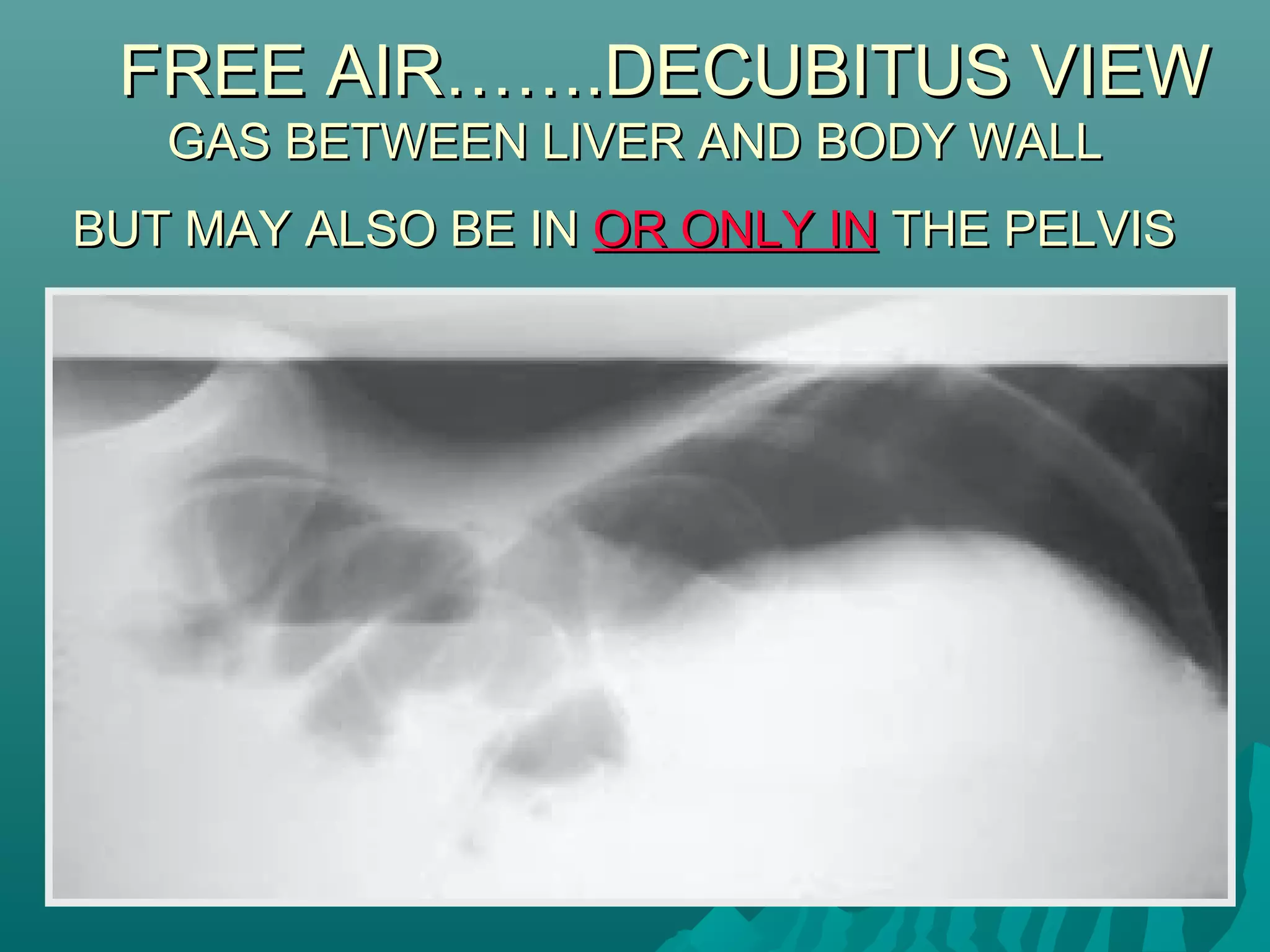 Abnormal gas | PPT | Lung and Respiratory Health | Diseases and Conditions