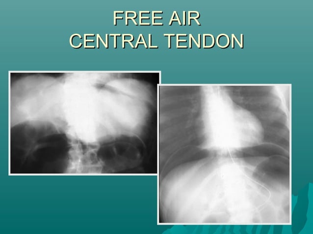 Abnormal gas | PPT | Lung and Respiratory Health | Diseases and Conditions