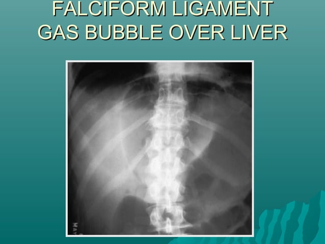 Abnormal gas | PPT | Lung and Respiratory Health | Diseases and Conditions