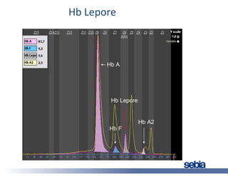 Rare Abnormal Hemoglobin Variants - Biochemistry | PDF
