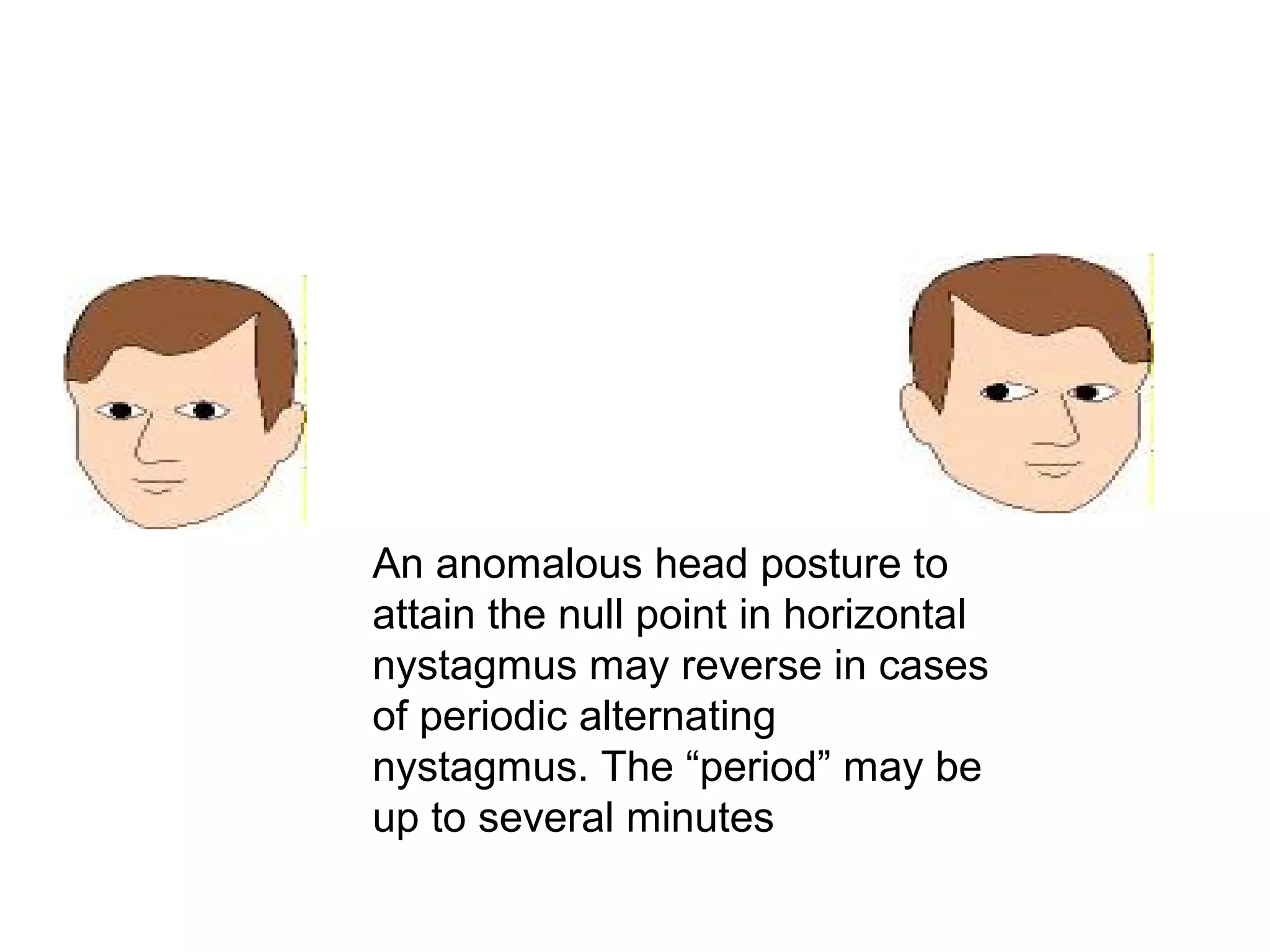 Abnormal Head Posture in squint | PPT