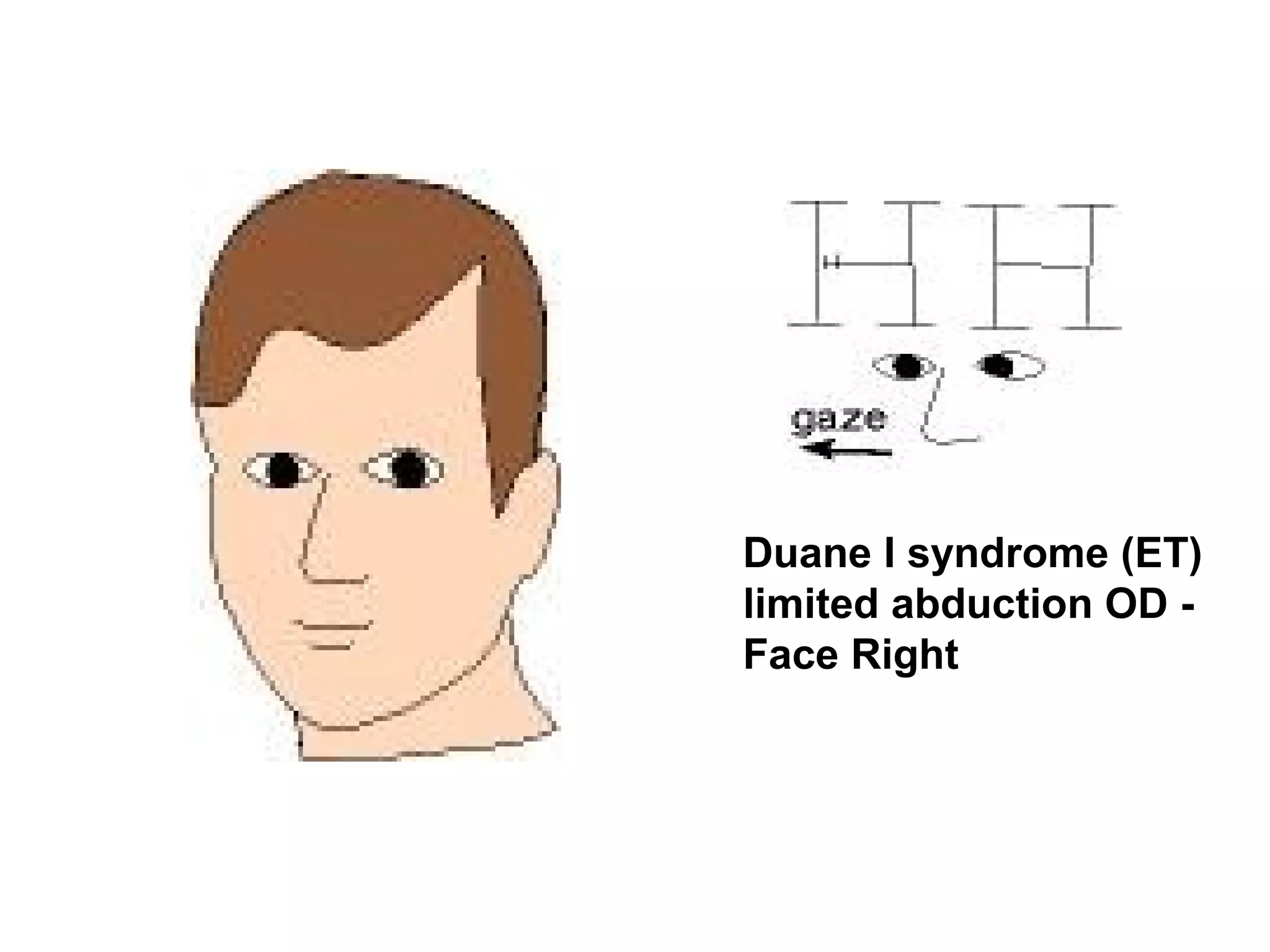 Abnormal Head Posture in squint | PPT