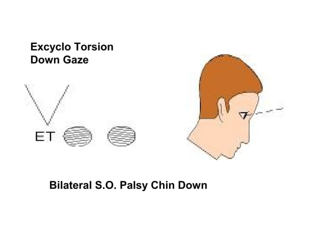 Abnormal Head Posture in squint | PPT | Eye and Vision Conditions ...