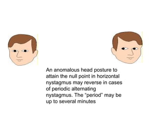 Abnormal Head Posture in squint | PPT