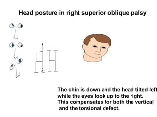 Abnormal Head Posture in squint | PPT