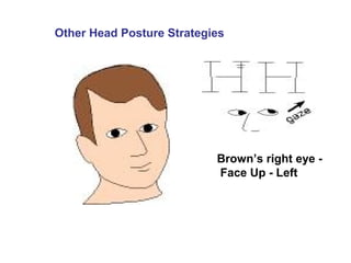 Abnormal Head Posture in squint | PPT