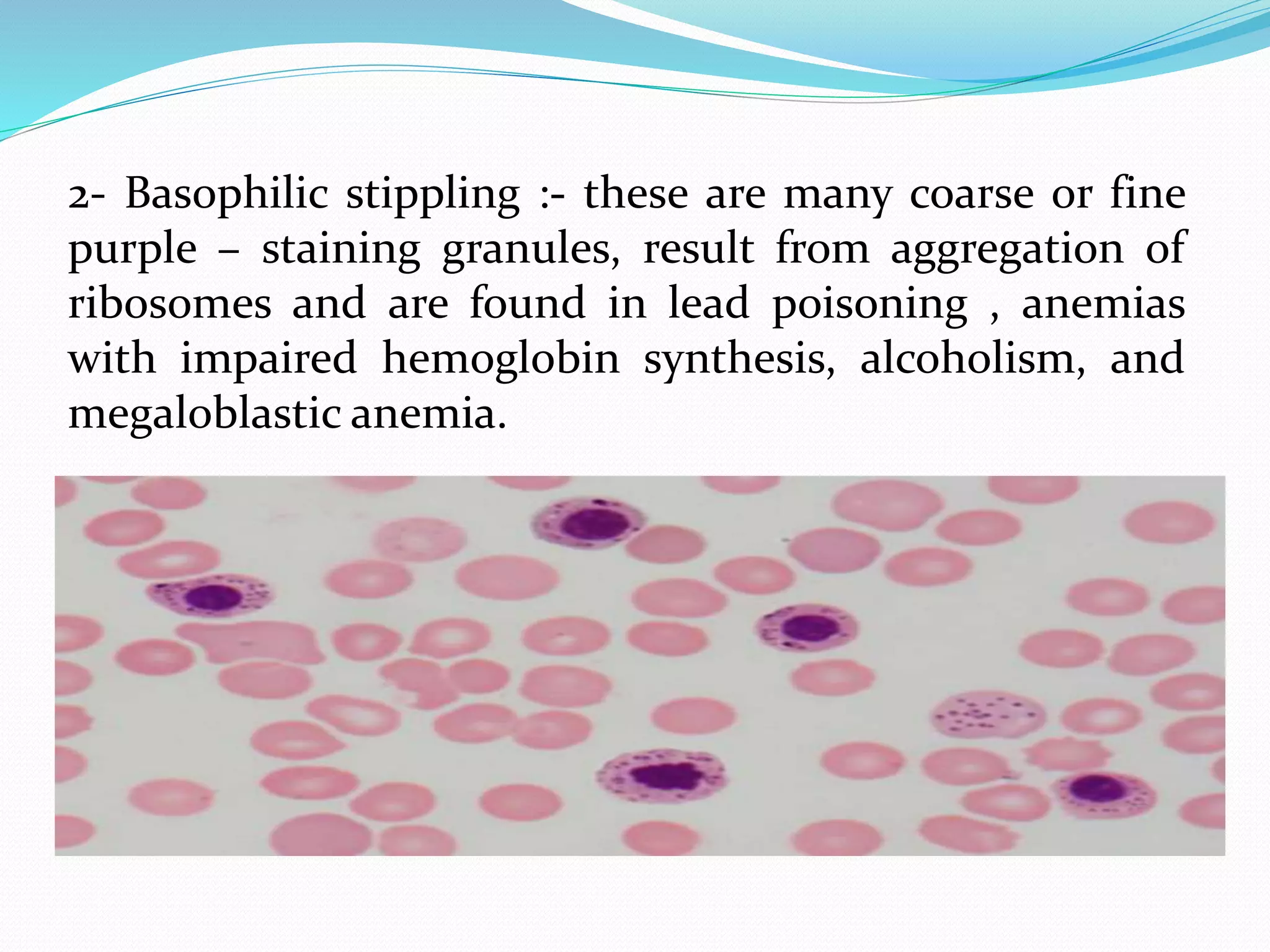 Abnormalities in color of RBCs | PPT