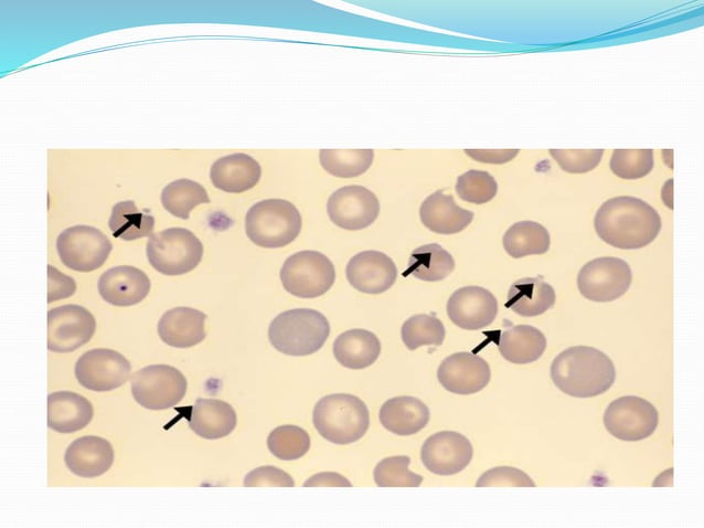 Abnormalities in color of RBCs | PPT