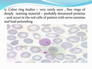 Abnormalities in color of RBCs | PPT