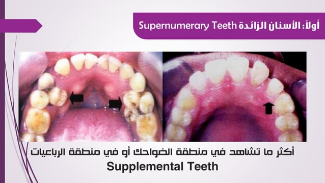Abnormalities in number of the teeth الاضطرابات العددية للأسنان | PPT