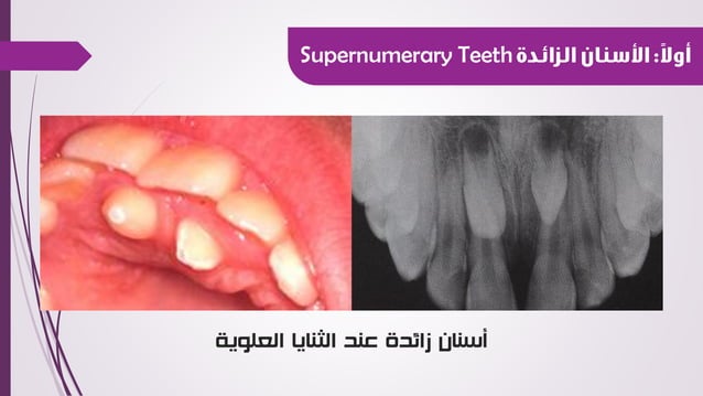 Abnormalities in number of the teeth الاضطرابات العددية للأسنان | PPT