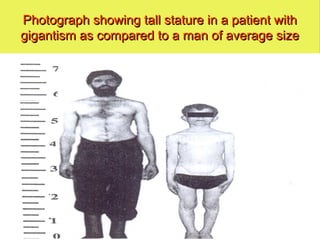 Abnormalities of anterior pituitary hormones | PPT