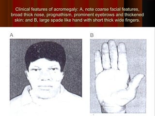 Abnormalities of anterior pituitary hormones | PPT