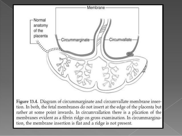 Circumvallate Placenta Diagram