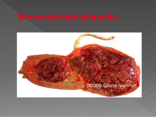 Abnormalities of cord & placenta