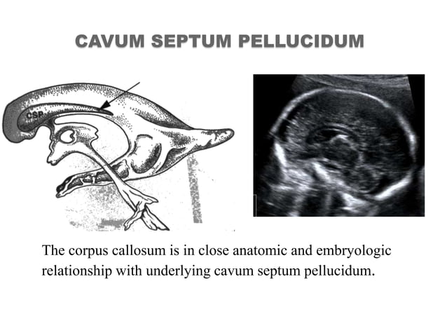 Abnormalities of Corpus Callosum | PPT