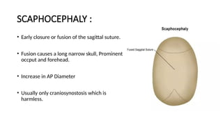 ABNORMALITIES OF HEAD SIZE AND SHAPE.pptx