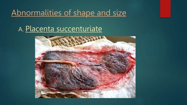 abnormalities of placenta.pptx