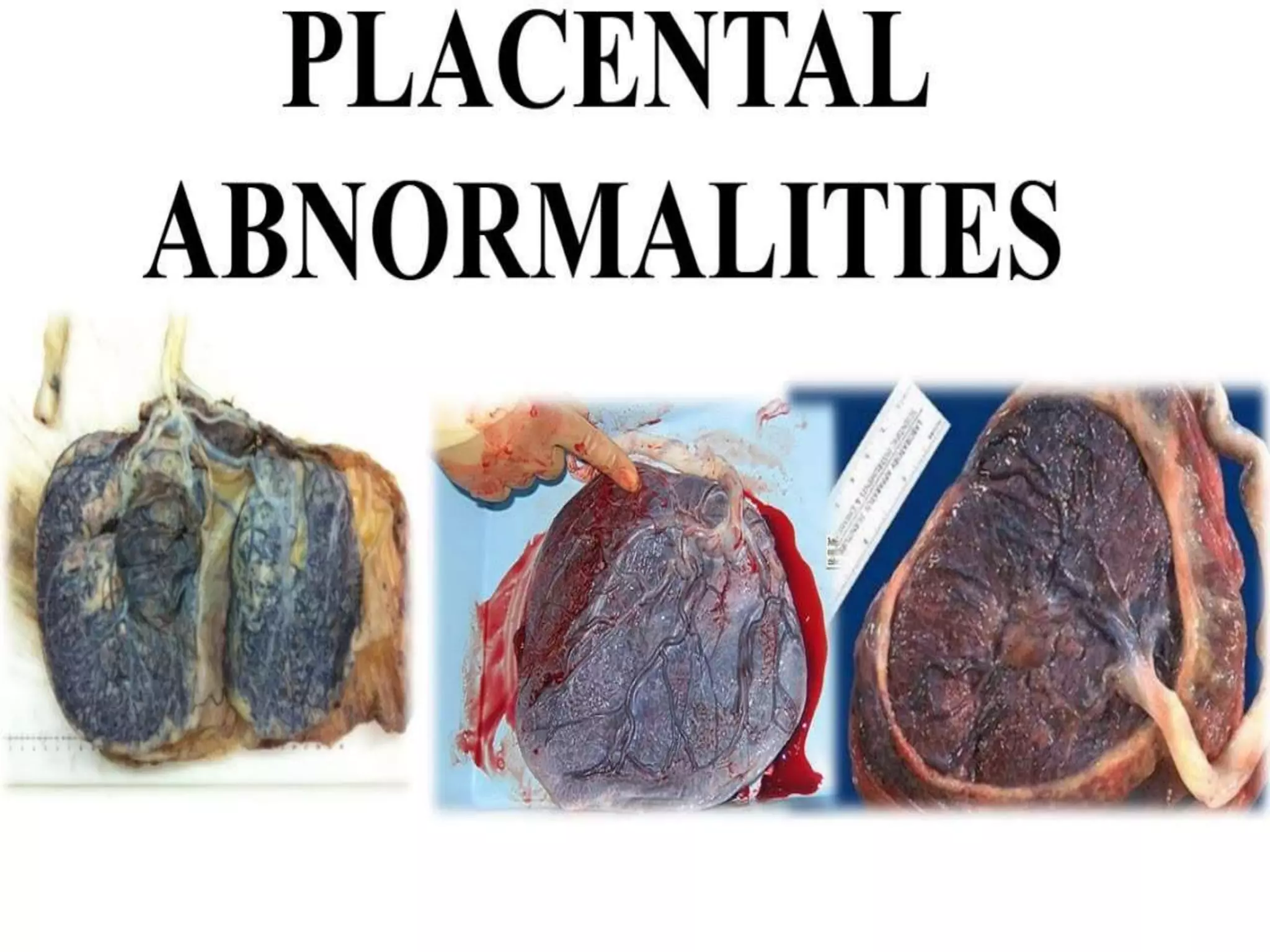 abnormalities of Placenta.pptx