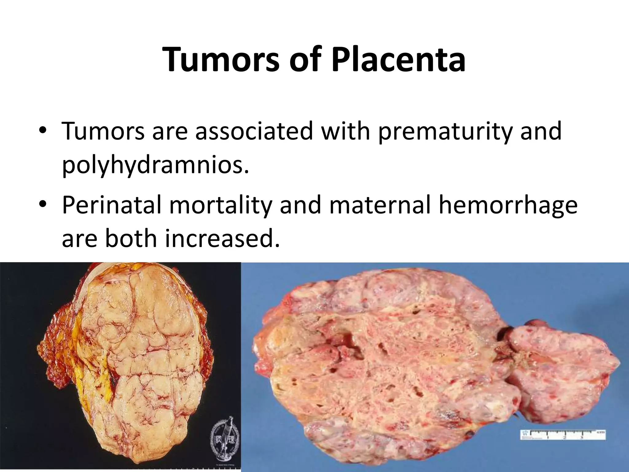 abnormalities of Placenta.pptx